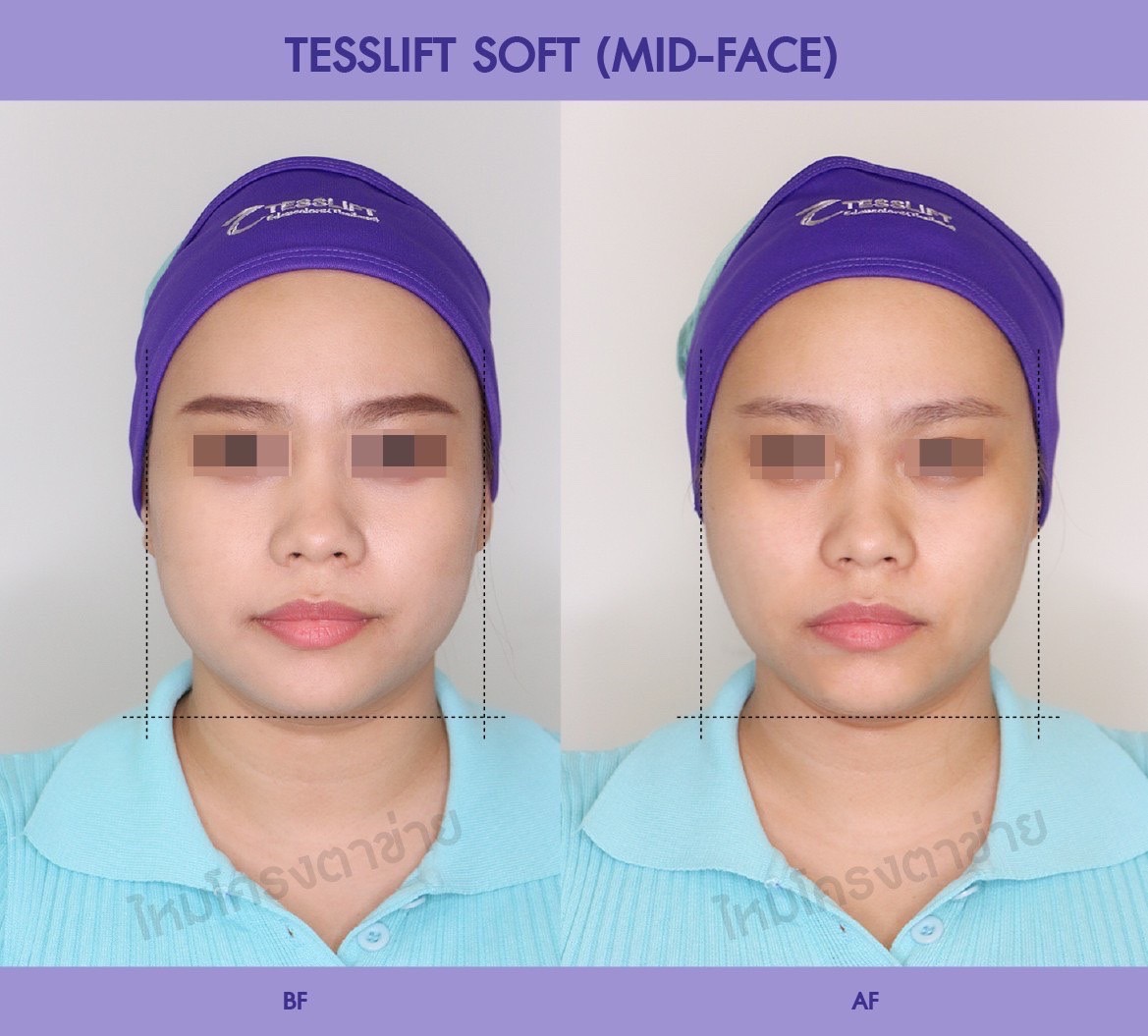 Tesslift - คลินิกเสริมความงาม ร้อยไหม ยกกระชับอันดับหนึ่ง