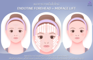 Endotine Face Lift - คลินิกเสริมความงาม ร้อยไหม ยกกระชับอันดับหนึ่ง