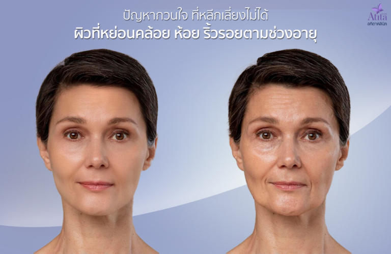 Endotine Face Lift - คลินิกเสริมความงาม ร้อยไหม ยกกระชับอันดับหนึ่ง